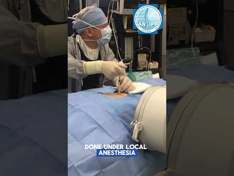 Lumbar Epidural Steroid Injection for Back Pain Relief | Dr. Dariusz Nasiek, MD