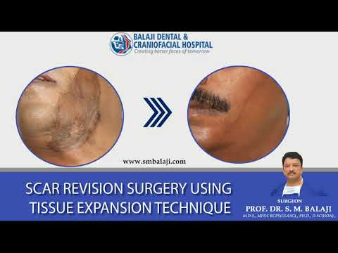 Scar Revision Surgery using Tissue Expansion Technique