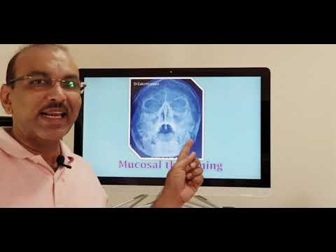 X ray sinuses (English) Patient teaching programme