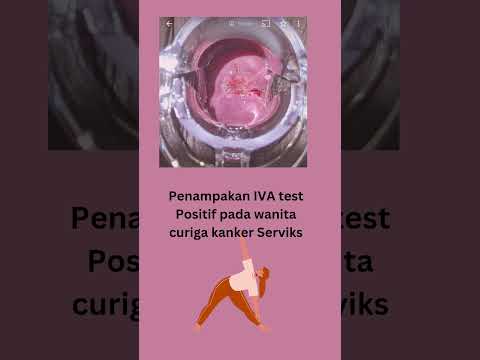 kanker serviks pada wanita #kankerserviks #kanker #wanita #kesehatanwanita #ivatest
