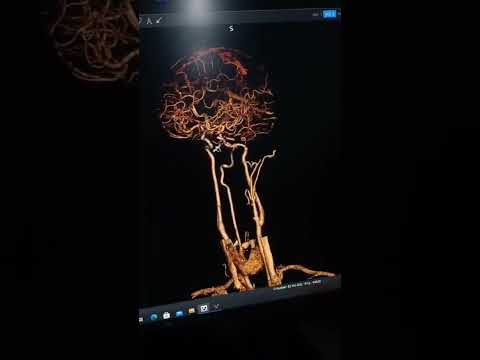 CTA brain ||CTA carotid arteries||cerebral CTA