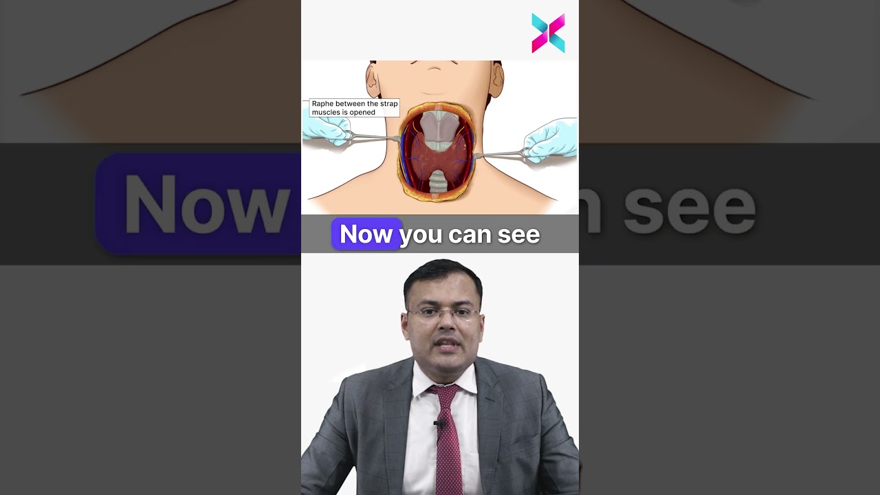 Thyroidectomy in 2 Minutes From Version X