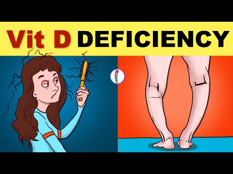 Vitamin D Deficiency | Vitamin D Deficiency Symptoms | Vitamin D Deficiency Rickets | Osteomalacia