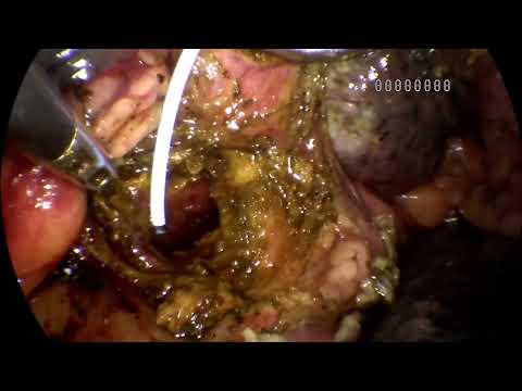 One-Stage Laparoscopic Cholecystectomy with CBD Exploration, Dr Shafei, Dr M.Elfatih