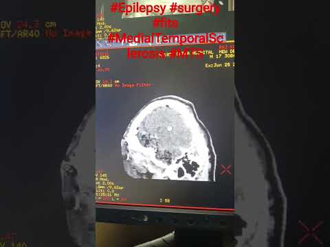 #epilepsysurgery #DNET #MTS #MedialTemporalSclerosis