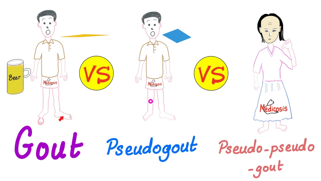 Gout vs. Pseudogout vs. Hydroxyapatite Arthropathy - Rheumatology Series