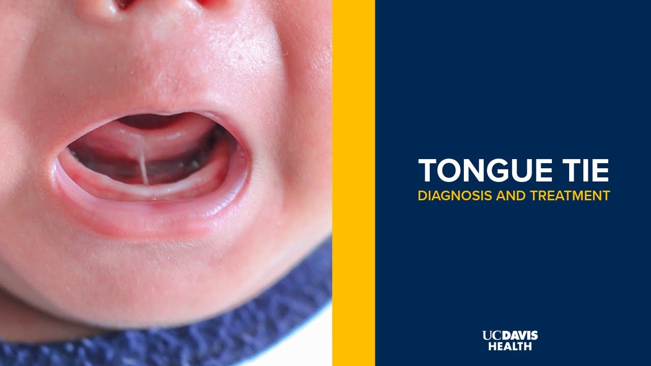 Tongue Tie (Ankyloglossia) Explained: Symptoms, Diagnosis & Treatment |  UC Davis Health