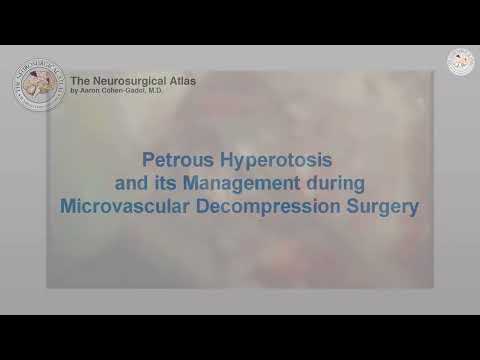Petrous Hyperostosis during MVD (Preview)