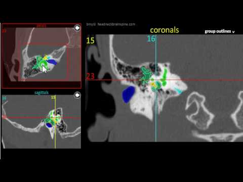 Temporal Bone CT Anatomy Module Tutorial