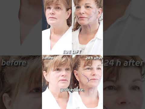 Patient Before And After EVE Lift™ | Eden Plastic Surgery: Dr. Ali Charafeddine, MD