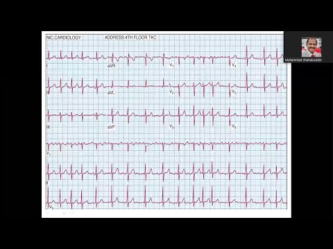 Arrhythmia by Prof. Muhammad Shahabuddin sir