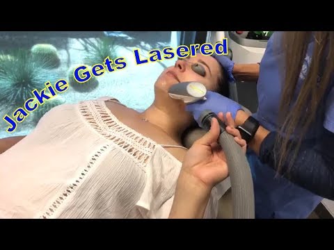 Jackie Gets Lasered! Sublative Laser Treatment for Acne Scars