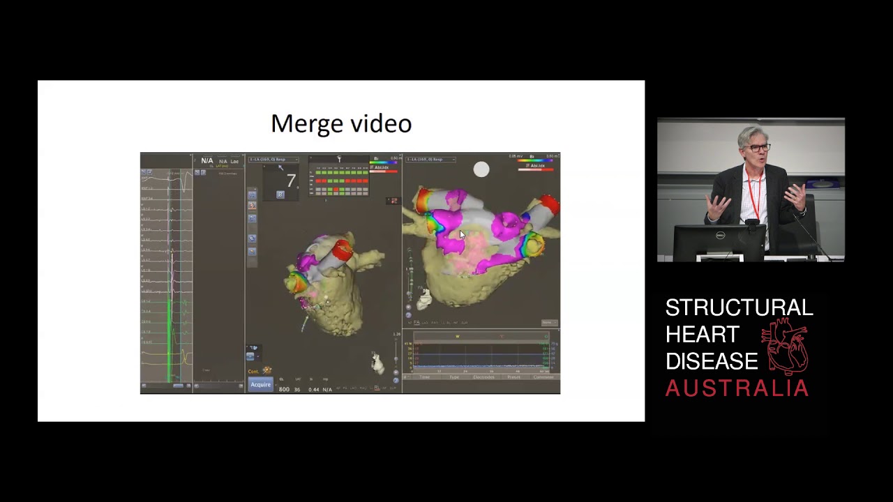 Where are we at with 3D Mapping: Electroanatomic Mapping - A/Prof Stuart Thomas