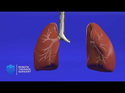 What Do I Need to Know About Lung Resection?
