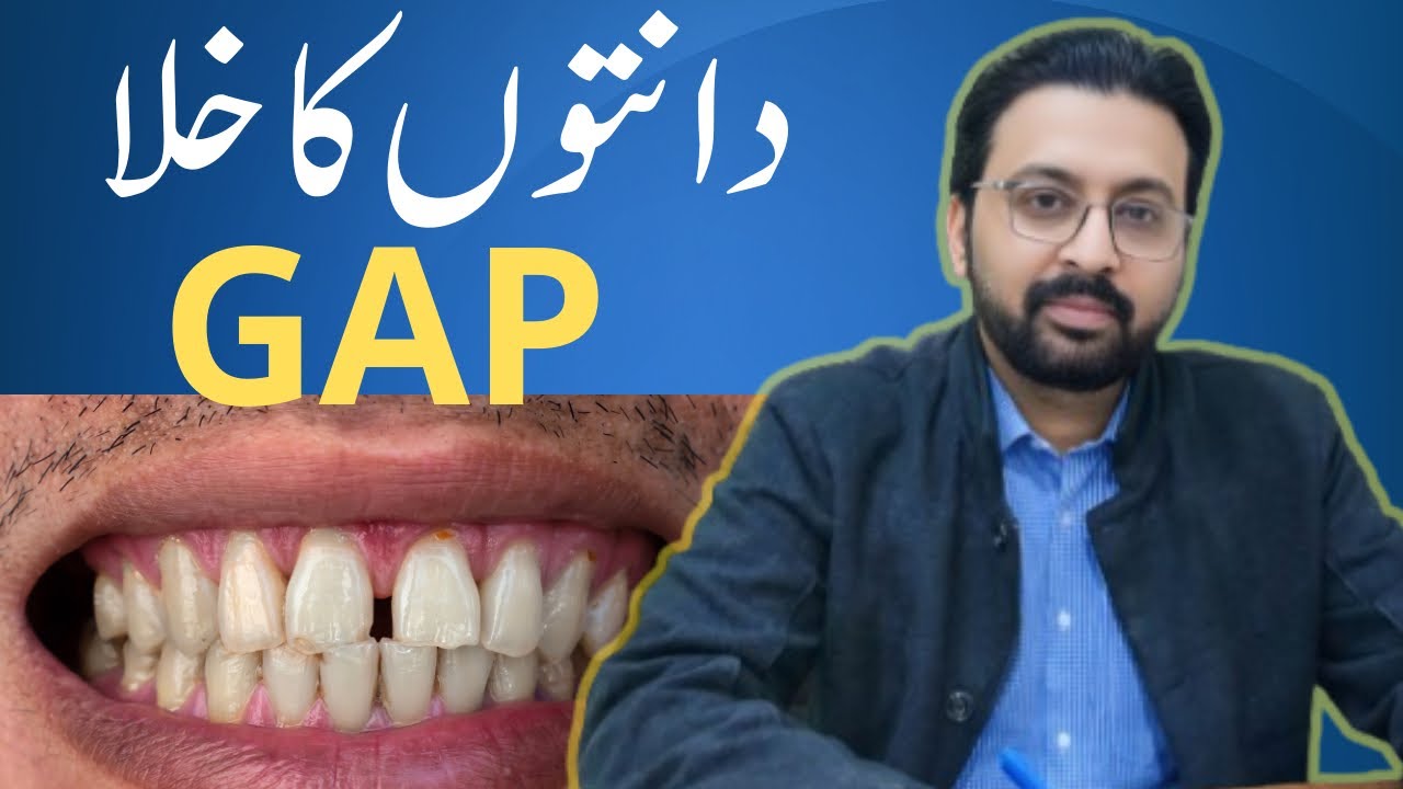 Close Gap in Teeth at Home FAST | No Braces, No Dentist — Easy Remedy!
