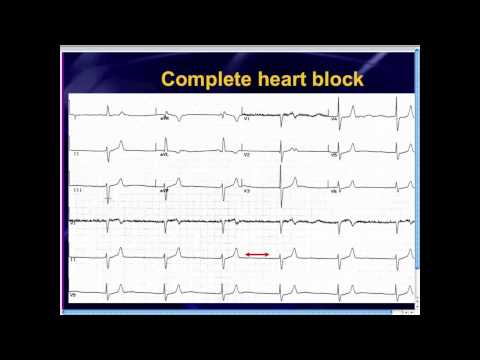 EMRAP TV 128 Are Those P Waves?