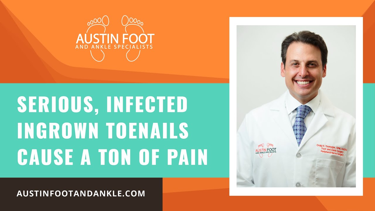 Serious, Infected Ingrown Toenails Cause a Ton of Pain