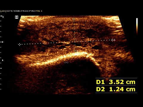 Ultrasound Diagnosis of Cellulitis in the Soft Tissues of the Left Elbow