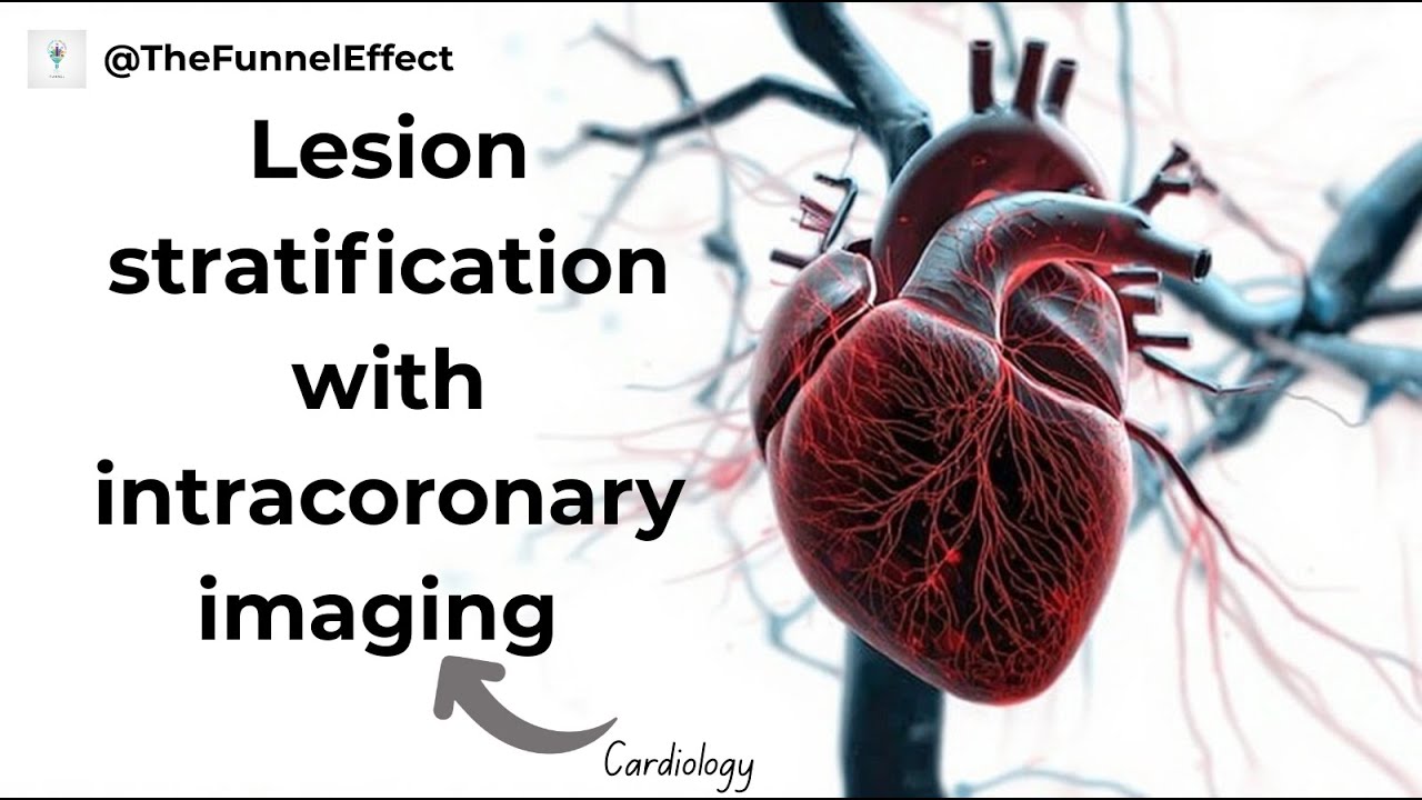 Lesion stratification with intracoronary imaging