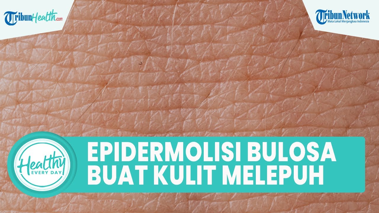 Mengenal Epidermolisi Bulosa yang Bisa akibatkan Kulit Melepuh, dari ...