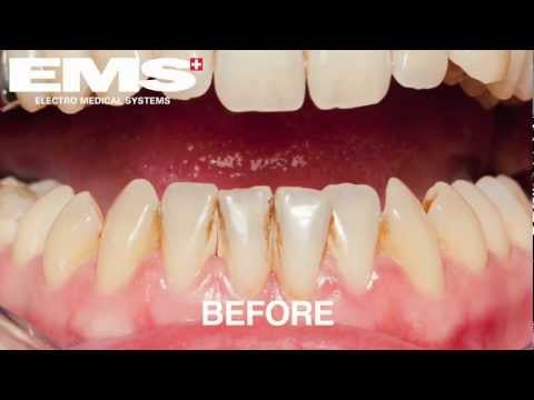 NHS Dentist EMS Airflow (TM)Cleaning