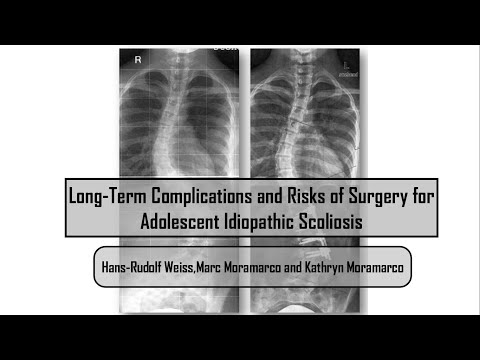 Long-Term Complications and Risks of Surgery for Adolescent Idiopathic Scoliosis