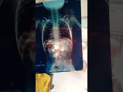 X-Ray Abdomen With FB Ap view on inkjet Film #paramedical #xray #alliedhealth #medical #doctor