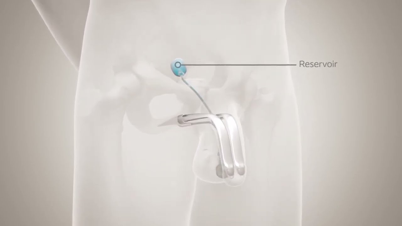 Inflating and Deflating the Titan Implant