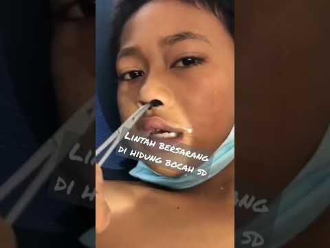 lintah bersarang di hidung bocah SD #shorts #viral