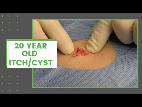 20 Year Old Itch/Cyst | Dr. Derm