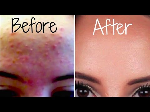 The Evolution Of Vitamin B5 For Acne – Broken Yoke