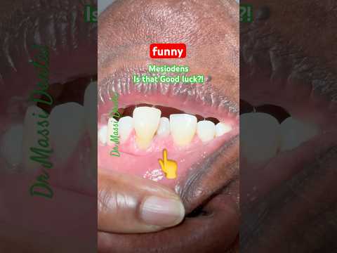 What are lucky teeth called?is supernumerary tooth is sign of good Luck !