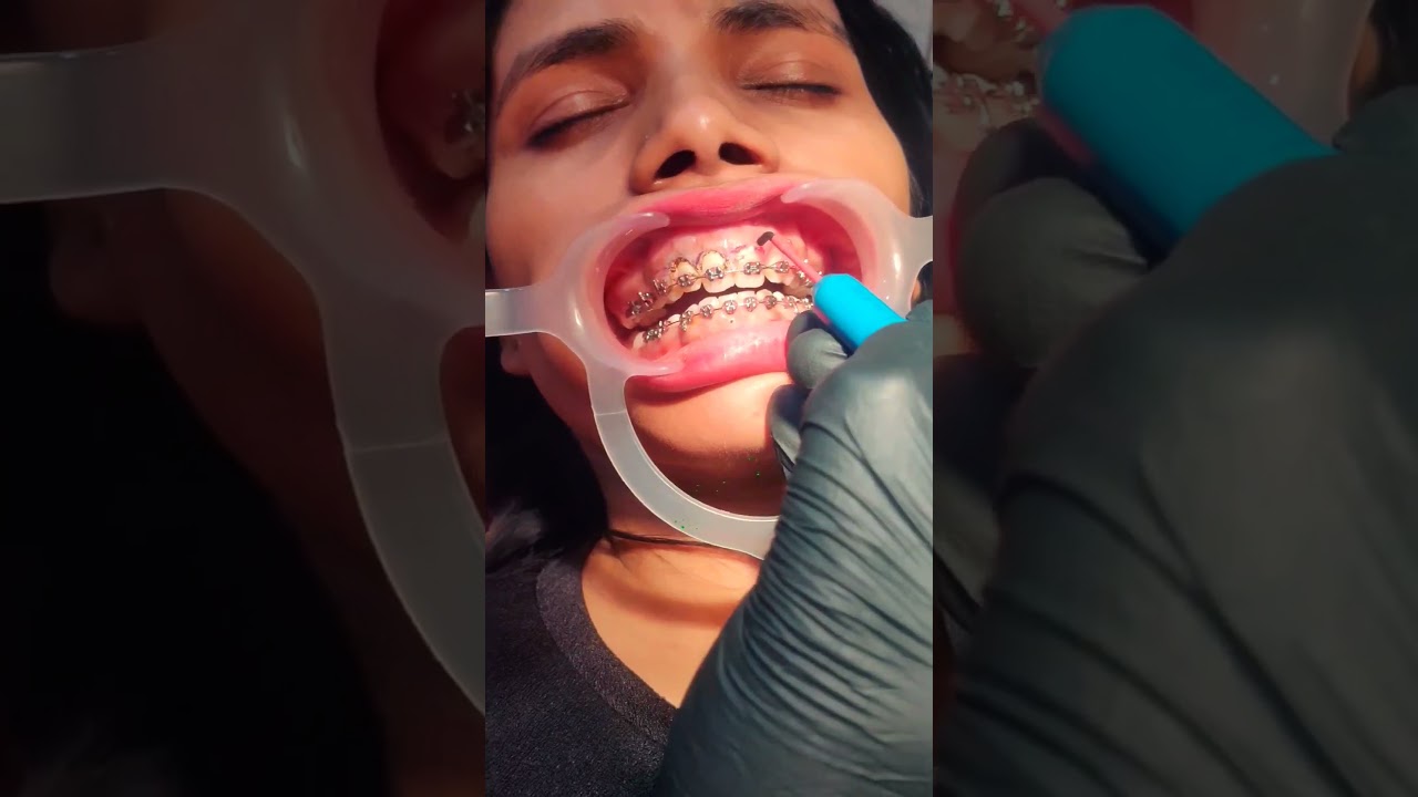 #laser gingivectomy##bhaskar cosmoclinic #electrocautery gingivectomy#Bhaskar cosmoclinic #uttam nag
