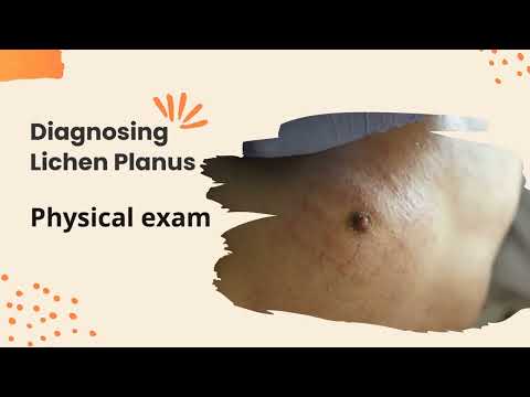 What is lichen planus
