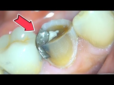 Dental Crown Procedure { Zirconia Crown Preparation w/ Microscope }