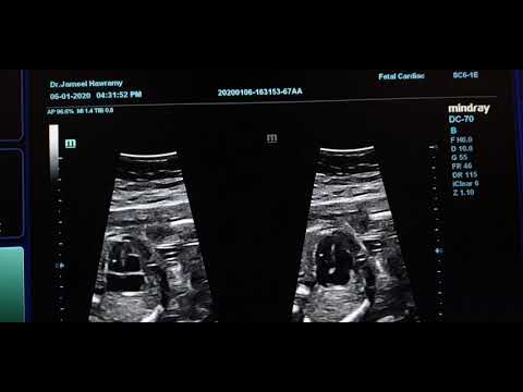 EIF within Left Ventricle of Fetal Heart