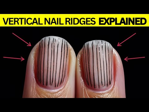 Stop Ignoring Vertical Nail Ridges! Here's What to Do