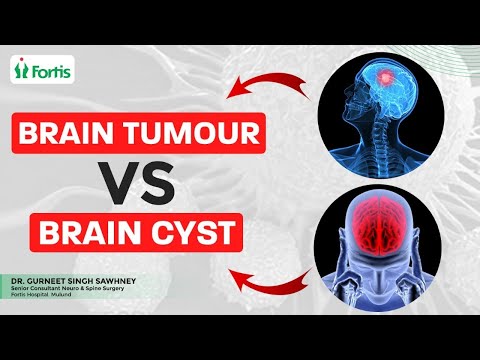 Brain Tumour Vs. Brain Cyst In Hindi | Kya Brain Cyst Life-Threatening Ho Sakta Hai? | MUL