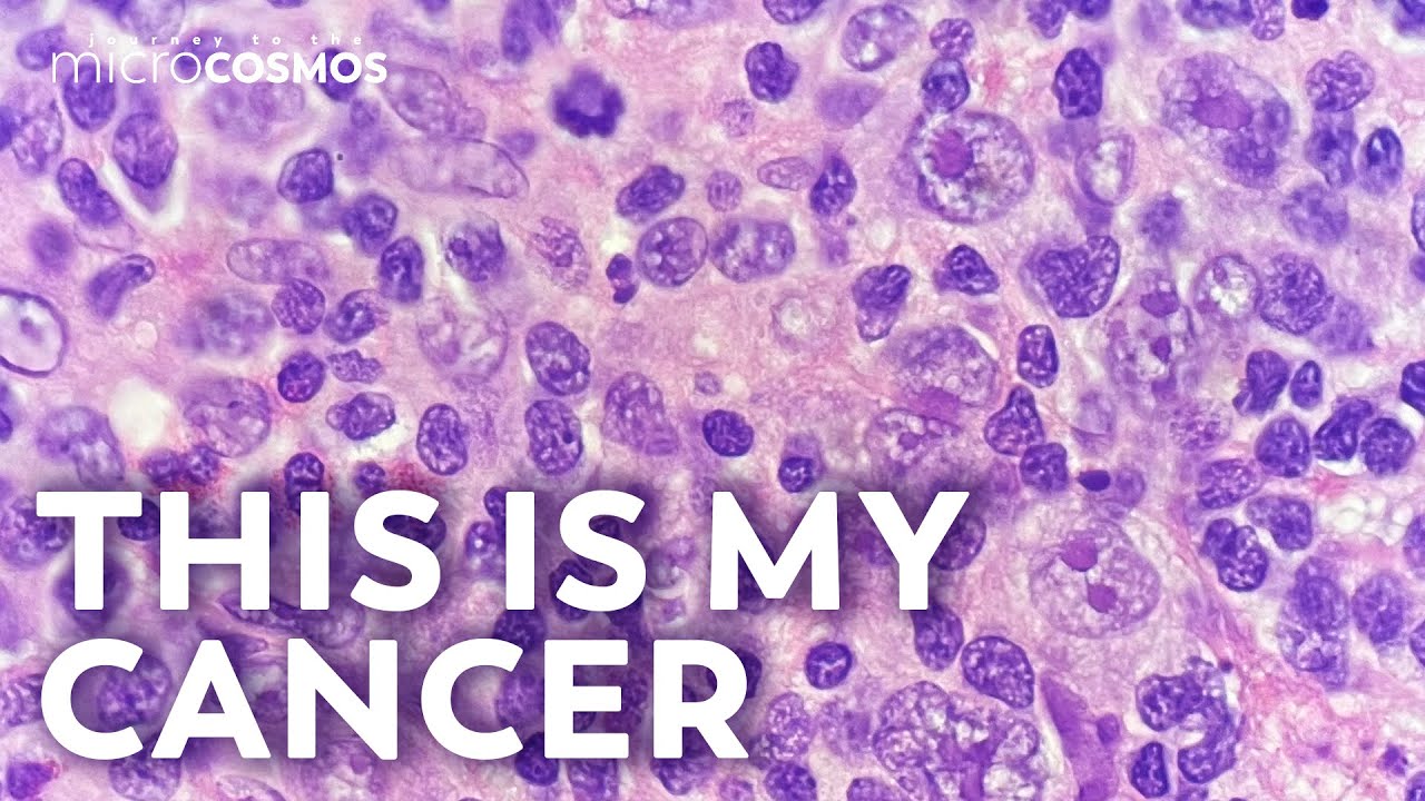 Understanding Cancer Through the Lens of Microscopy | Galaxy.ai