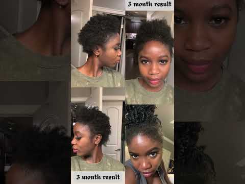 Amazing hair Loss transformation #hairloss #hairgrowth #viral