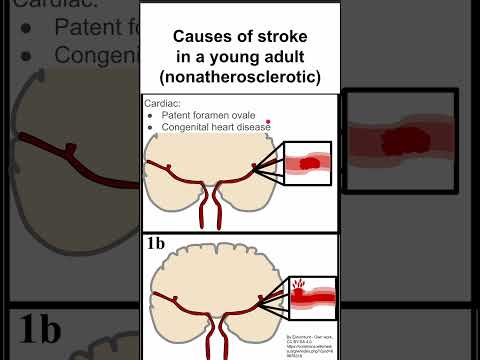 Causes of stroke in a young adult (nonatherosclerotic)
