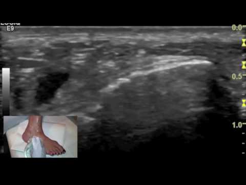 Ultrasound tutorial - Imaging of the peroneal tendons
