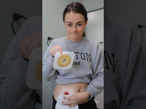 Realistic Ostomy Change - When Your Stoma is a Volcano | #ostomy | Let's Talk IBD