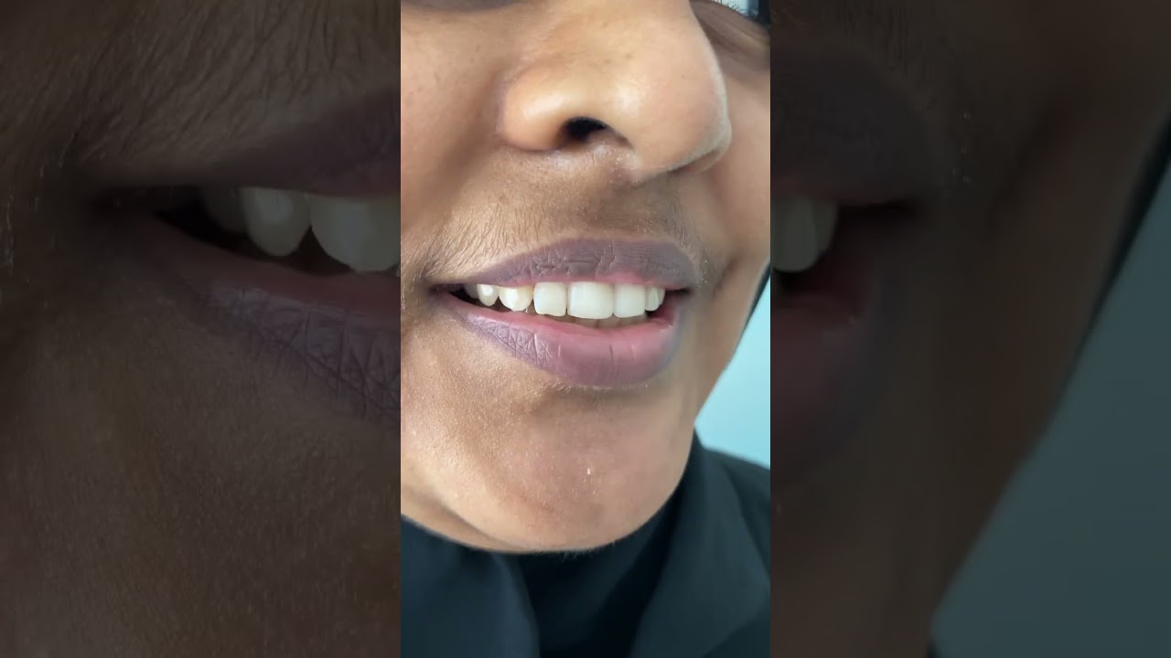 Gap between front teeth??? Solution in 1 day!!! at mala,Thrissur 📞8921193206#dentist#dentalclinic l