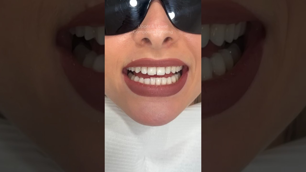 Upper & Lower Composite Bonding Makeover ❤️