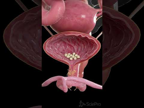 🪨 Bladder Stones: What You Need to Know 🪨 #anatomy