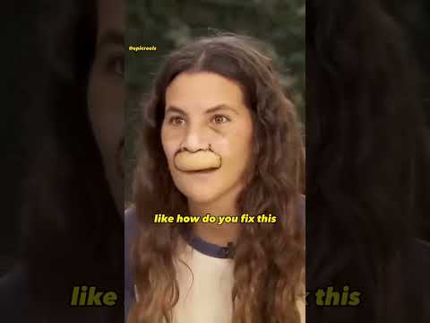 Young Model Shares Lip Transformation After Dog AttackβΌοΈπ± #shorts