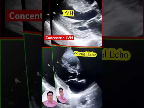 Concentric LVH Echo l Left ventricular hypertrophy l #lvh #echo #shorts