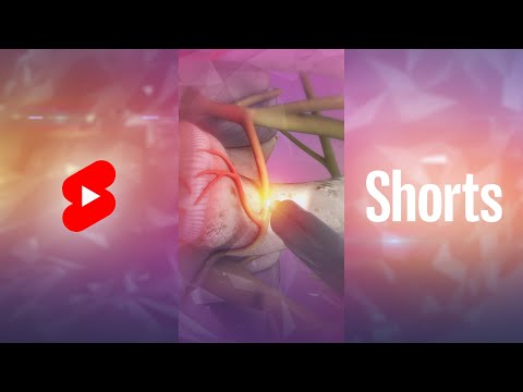 What is Endoscopic Facet Rhizotomy? #Short