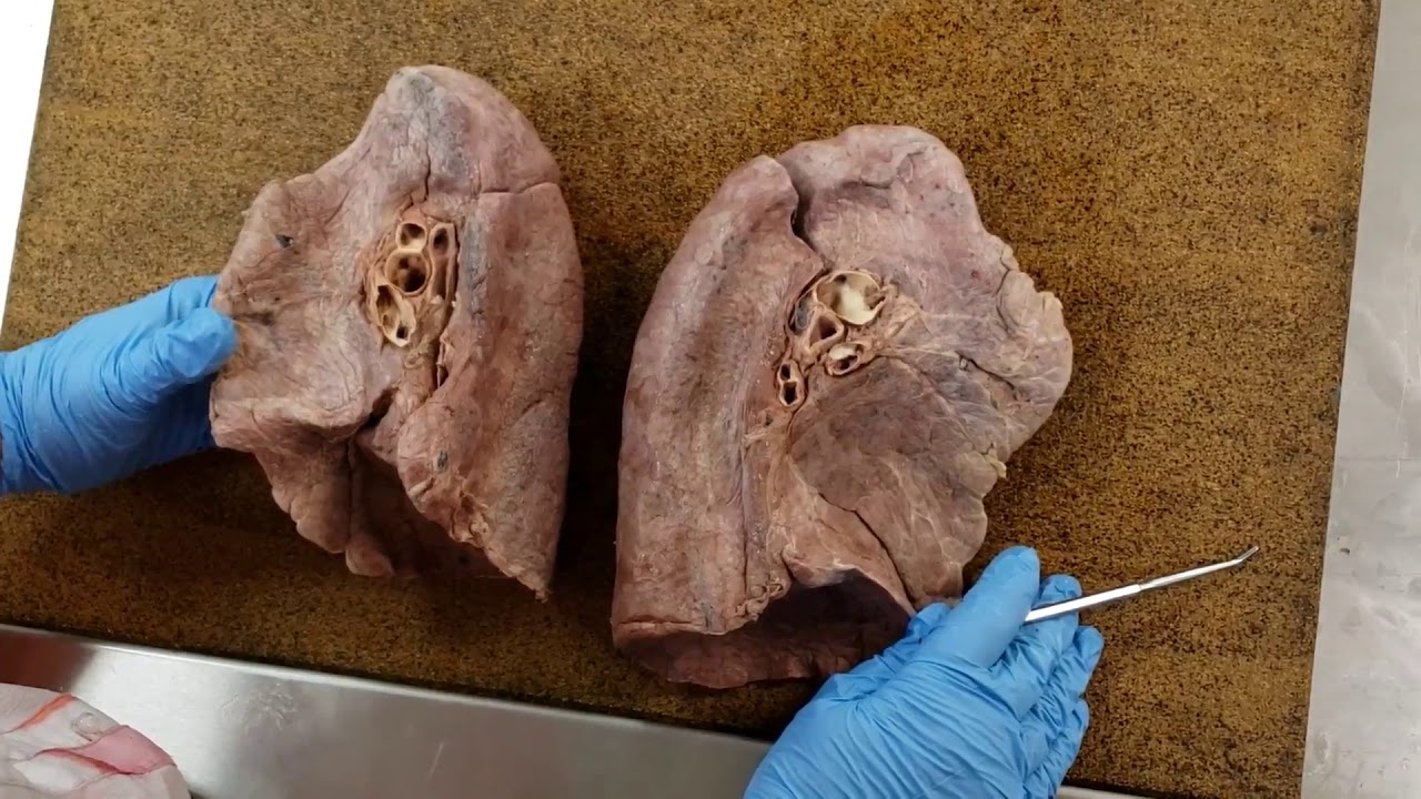 Lungs: How can you differentiate right from left?